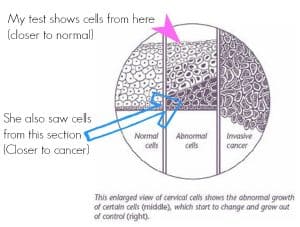 Cervical Cancer Stages Explained - Saving Dollars & Sense